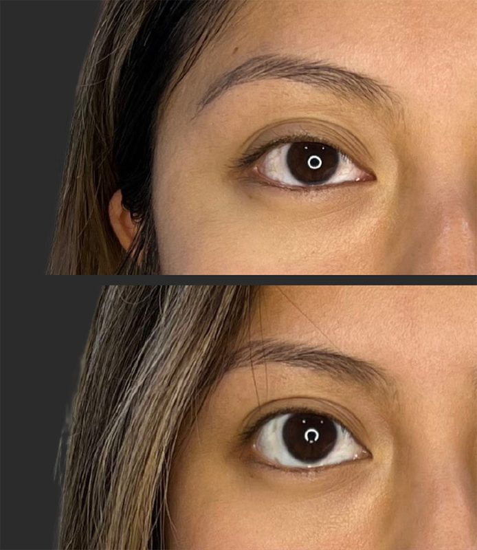 Upneeq Eye Lifting Drops - Health Source Online