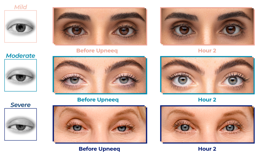 Upneeq Eye Lifting Drops - Health Source Online Upneeq Eye Lifting Drops - Health Source Online